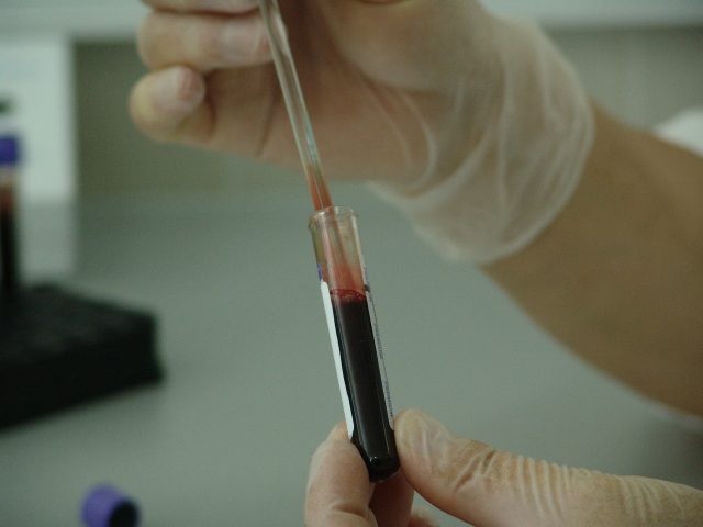 Hyperuricemia Symptoms and Treatment Guidelines