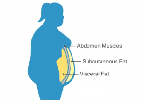 Obesity And Gout: How Being Overweight Causes Gout